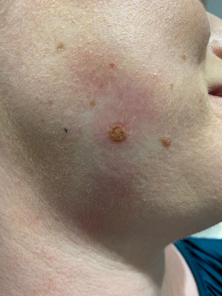 A Mole Turns Into Scab