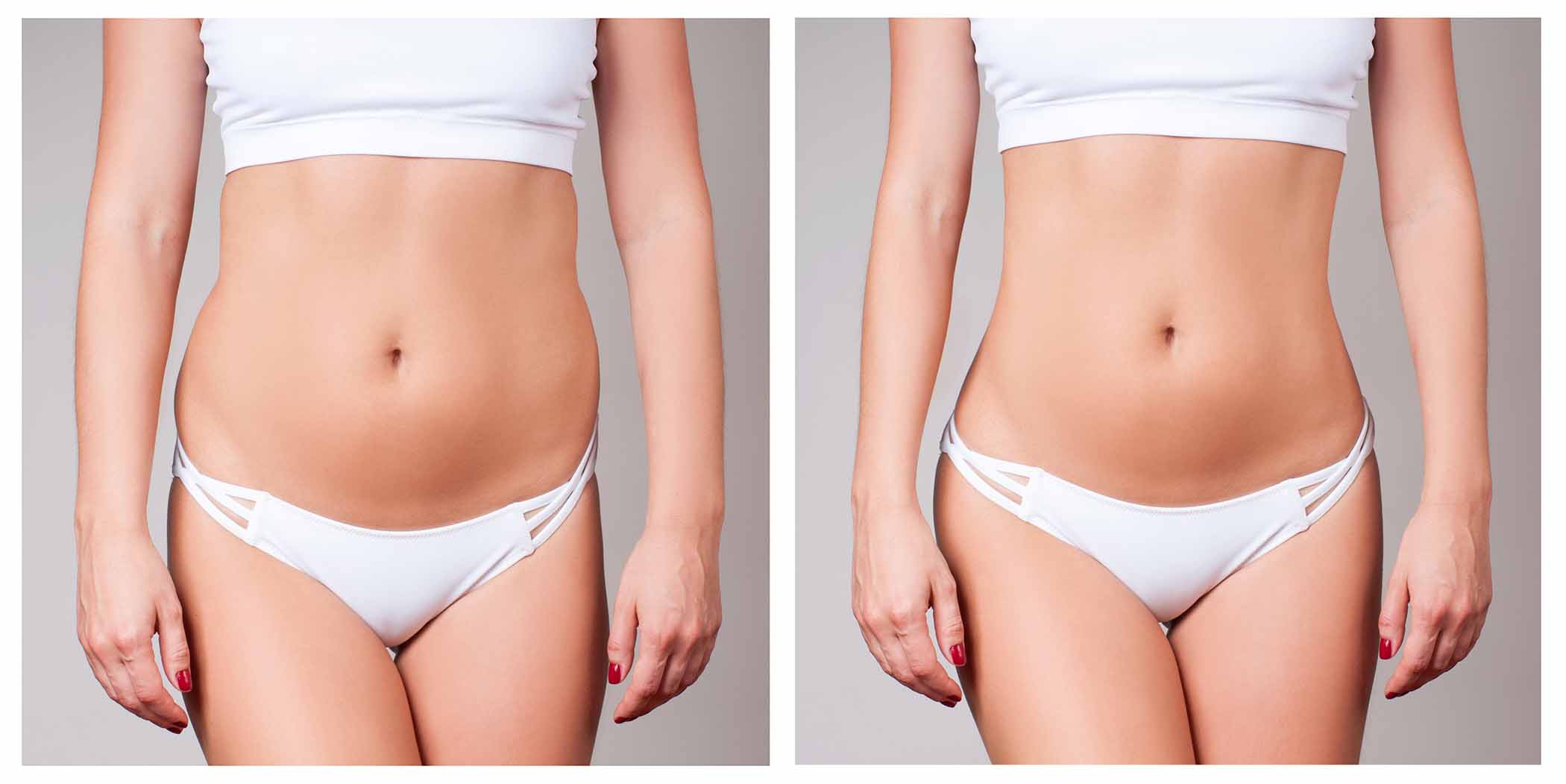 Fat Dissolving Injections Injection For Fat Reduction LasaDerm Fat Dissolving Injections Injection For Fat Reduction LasaDerm
