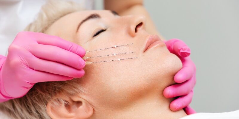 What Is A Thread Lift? A Comprehensive Guide