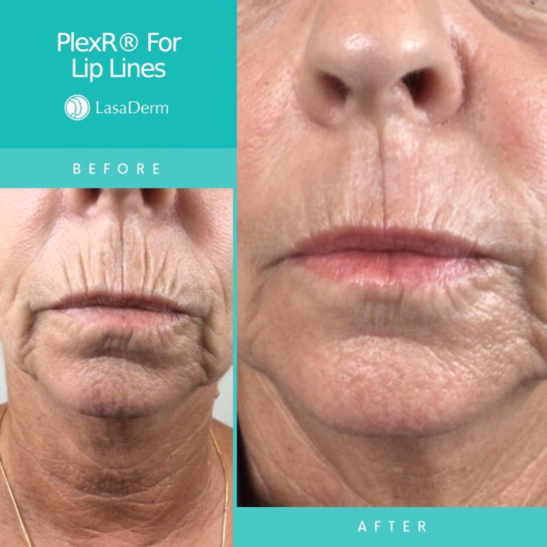 PlexR® For Lip Lines - LasaDerm