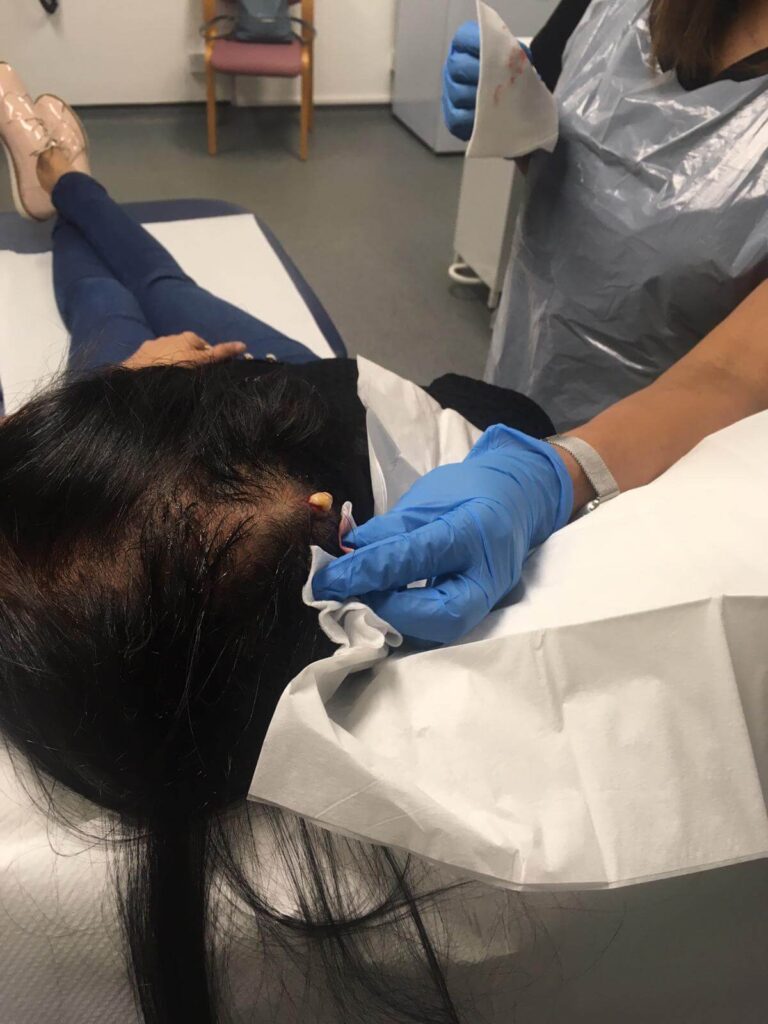 Erika's Cyst Removal - LasaDerm
