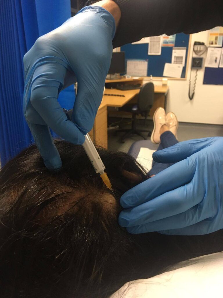 Erika's Cyst Removal - LasaDerm